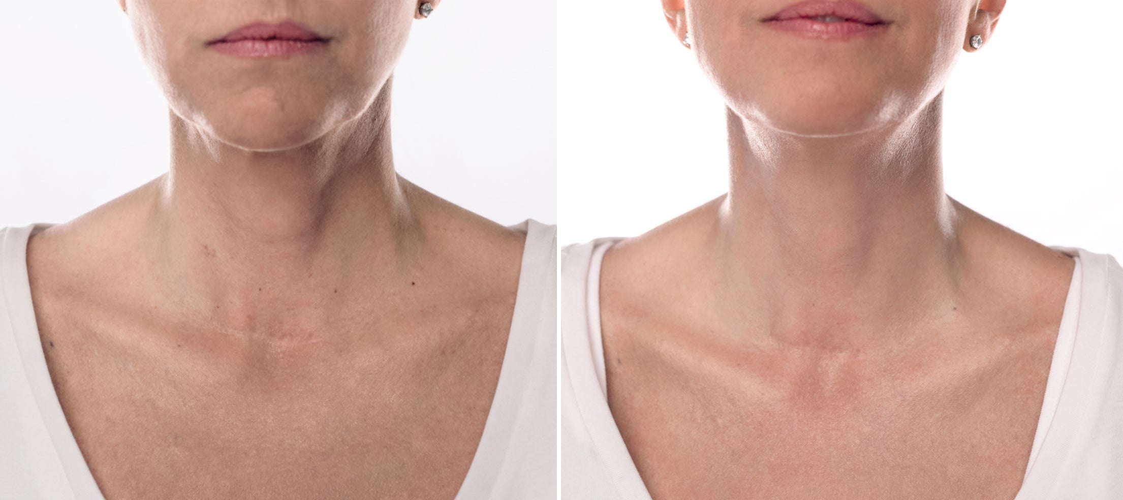 Best Non Surgical Ways to Tighten a Loose Neck: Top Solutions to Try ...