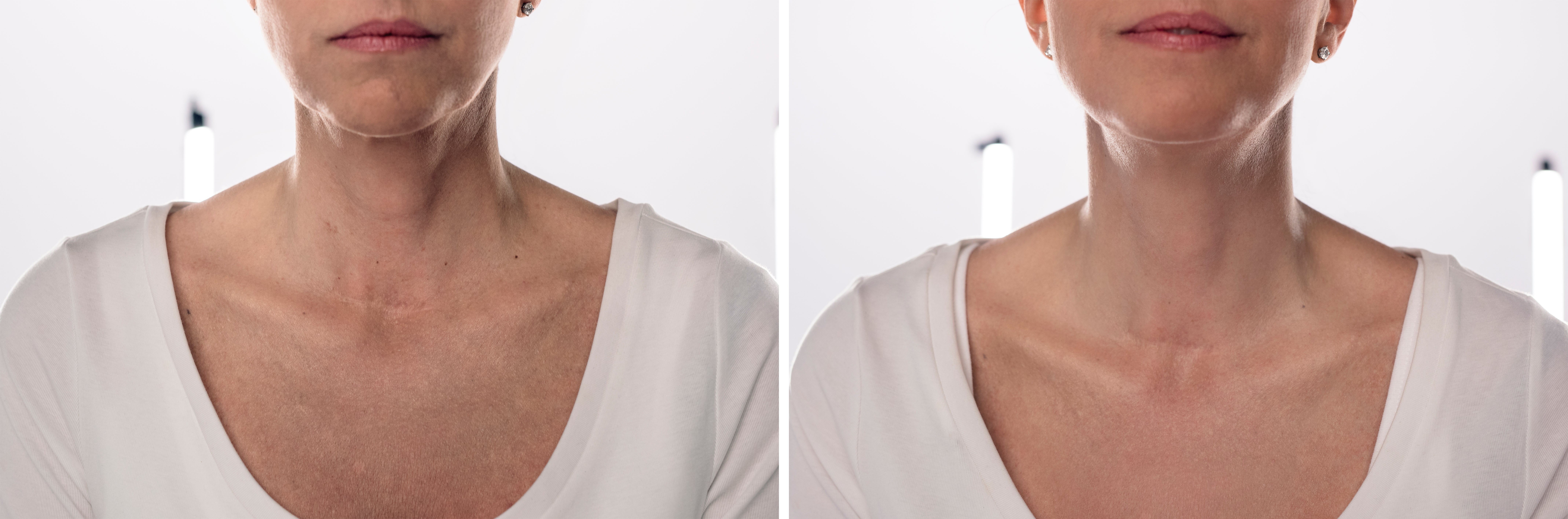 Early Signs of Neck Aging Women Overlook and How to Address Them – SBLA ...