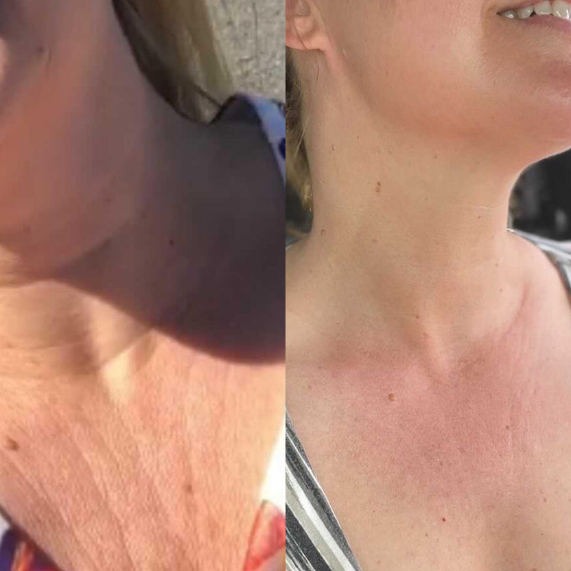 How Sun Damage Accelerates Neck Aging and Effective Prevention Tips ...