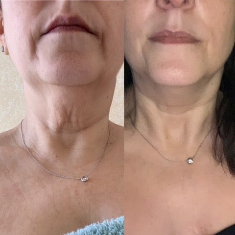 How to Prevent Crepey Neck Skin: Effective Tips for Youthful Texture ...